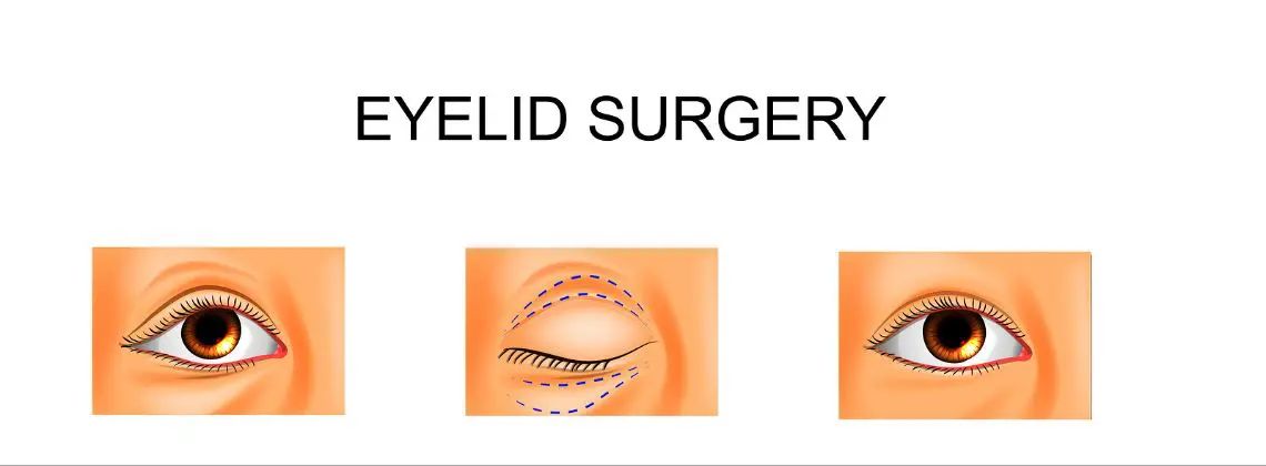 Eyelid lift Archives - Wellesley Cosmetic Surgery | Dr. Shektman